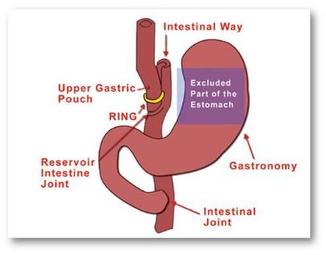 Cirurgia Bariátrica e suas Consequências na Cavidade Oral, Artigo | iDent