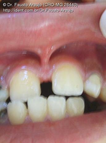 Frenectomia Labial Superior, Caso clínico | iDent