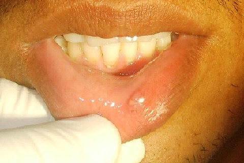 Sarcoma de Kaposi em Lábio Inferior, Caso clínico | iDent