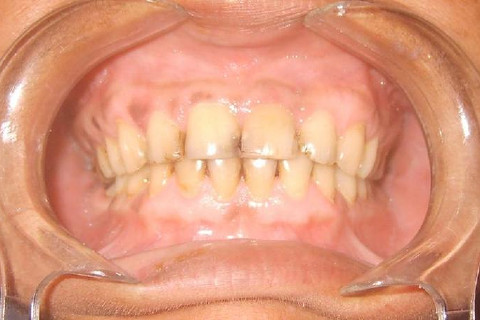 Leucoplasia em Borda de Língua Sugestiva de Malignização, Caso clínico ...