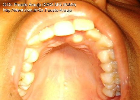 Supra Numerário, Caso clínico | iDent