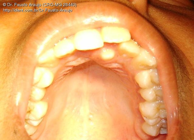 Supra Numerário, Caso clínico | iDent