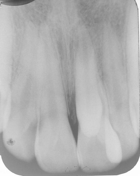 Supra Numerário, Caso clínico | iDent