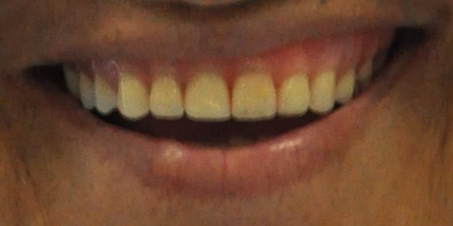 Prótese Total Imediata: Relato de Caso Clínico, Caso clínico | iDent