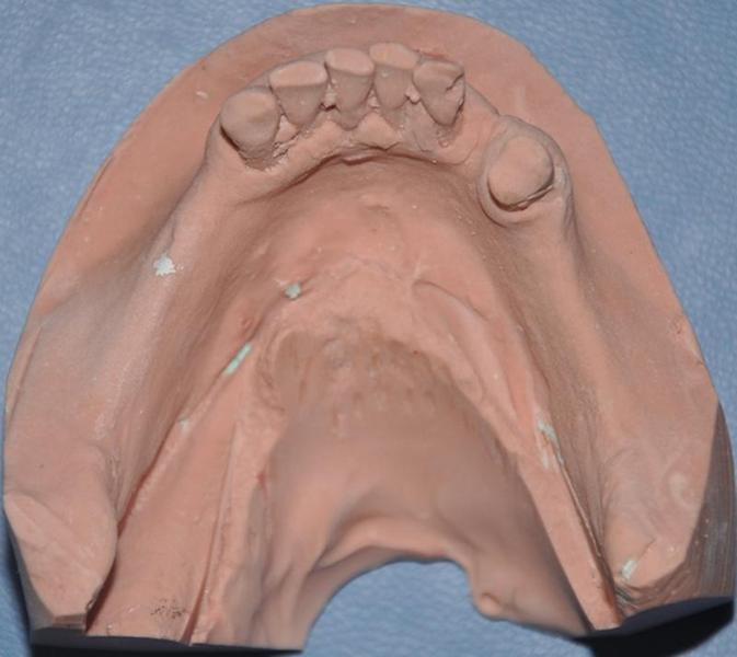 Prótese Total Imediata: Relato de Caso Clínico, Caso clínico | iDent