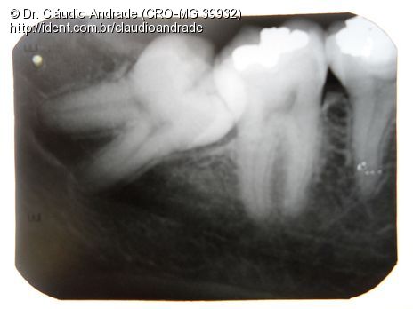 Exodontia do Dente 48 com Inclusão Mesio-Angular e Impactado no 47 ...