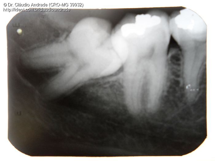 Exodontia do Dente 48 com Inclusão Mesio-Angular e Impactado no 47 ...