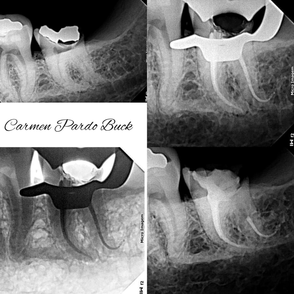 Endodontia em Dente do Siso. Dente 38, Caso clínico | iDent