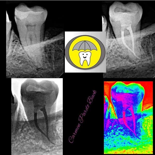 Endodontia em 3° Molar Inferior, Caso clínico | iDent