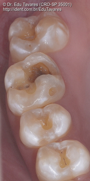 Inlays Cerâmicos., Caso clínico | iDent