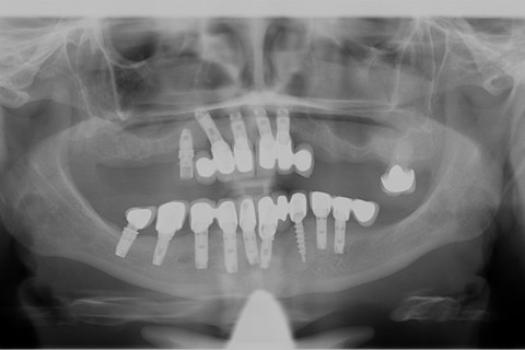 Coroa em Cerômero no 11, Caso clínico | iDent