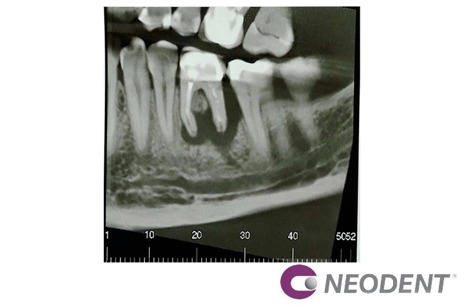 Reconstrução Alveolar com Straumann® Cerabone® + Straumann® Collprotect ...