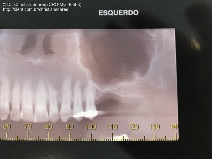 Levantamento da Membrana do Seio Maxilar, Caso clínico | iDent