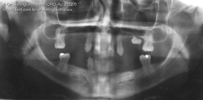 Dentes Inclusos Interessantes, Caso clínico | iDent