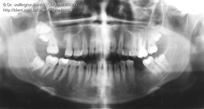 Dentes Inclusos Interessantes, Caso clínico | iDent