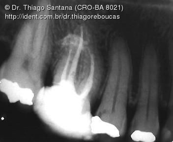 Canal Dente 26, Caso clínico | iDent
