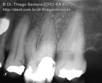 Canal Dente 26, Caso clínico | iDent