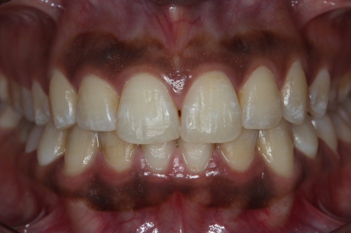 Remoção de Pigmentação Melânica Através da Técnica de Abrasão Epitelial ...