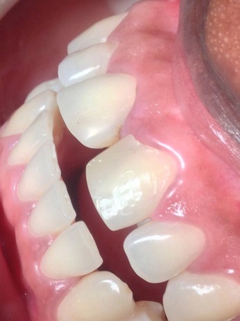 Restauração Estética Dentes 11 e 21, Caso clínico | iDent