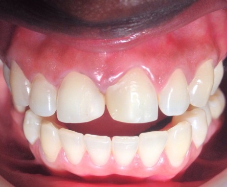 Restauração Estética Dentes 11 e 21, Caso clínico | iDent