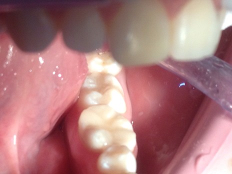 Dente 36, Caso clínico | iDent