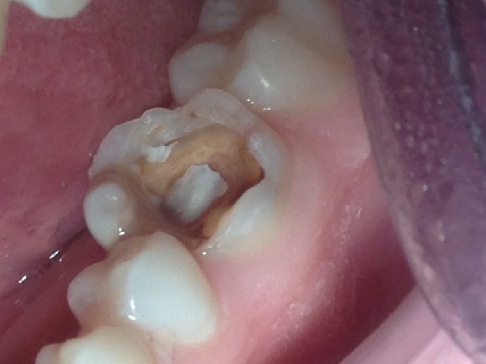 Dente 36, Caso clínico | iDent