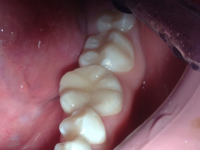 Dente 36, Caso clínico | iDent