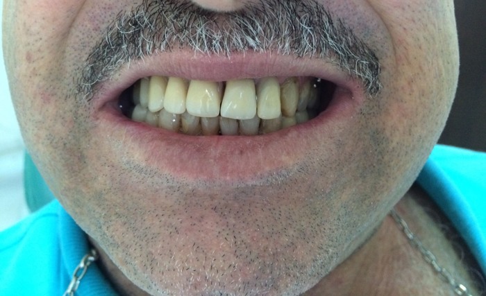 Reabilitação Oral Através de Ppr Conjugada com Próteses Fixas, Caso ...