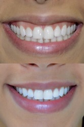 Aplicação de Toxina Botulínica em Sorriso Gengival Assimétrico, Caso ...