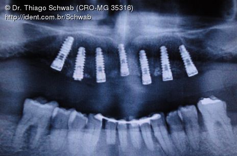 Protocolo Superior e Imediato Inferior, Caso clínico | iDent