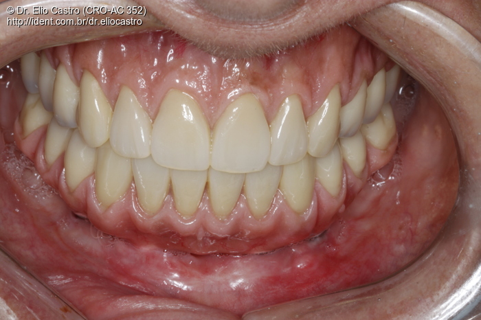 Reabilitação Estética e Funcional com Prótese Total Superior e ...