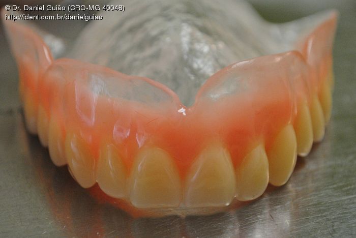 Substituição de Ptr Superior e Confecção de Ppr Inferior, Caso clínico ...