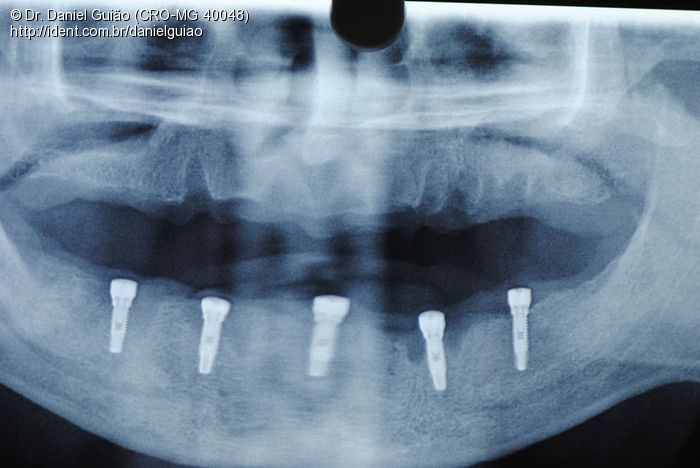 Protocolo Inferior Sobre 5 Implantes, Caso clínico | iDent