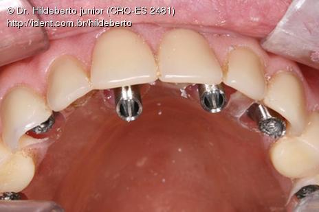 Reabilitação Mista, Caso clínico | iDent