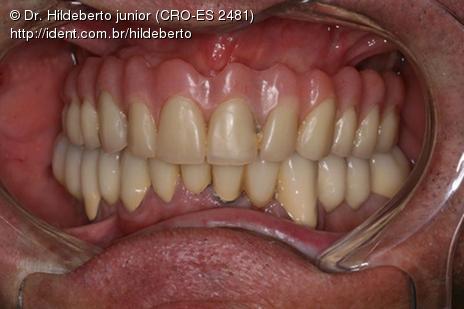 Reabilitação Mista, Caso clínico | iDent