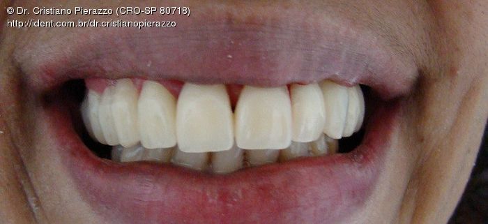 Provisório Sobre Dentes e Implante., Caso clínico | iDent