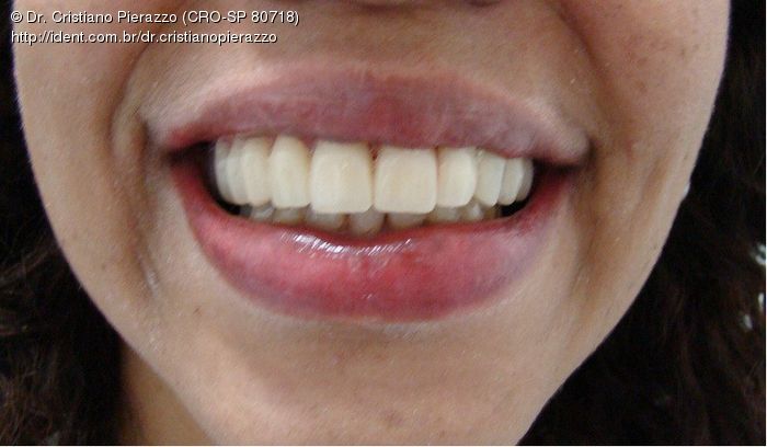 Provisório Sobre Dentes e Implante., Caso clínico | iDent