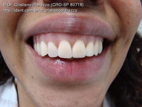 Provisório Sobre Dentes e Implante., Caso clínico | iDent