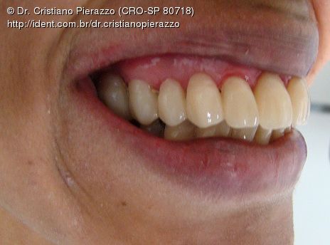 Provisório Sobre Dentes e Implante., Caso clínico | iDent