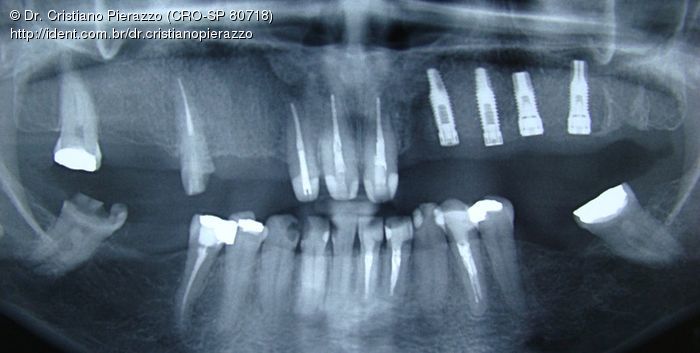 Provisório Sobre Dentes e Implante., Caso clínico | iDent