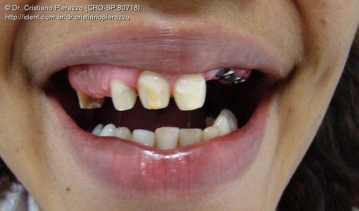 Provisório Sobre Dentes e Implante., Caso clínico | iDent