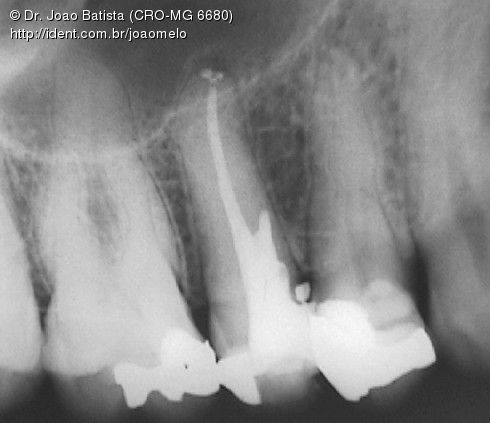Calcificação Distrófica, Caso clínico | iDent