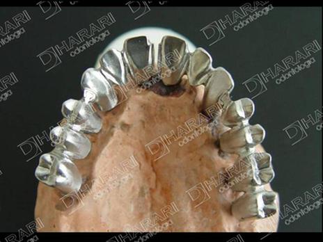 Prótese Total Cimentada Sobre Implantes (Arco Superior), Caso clínico ...