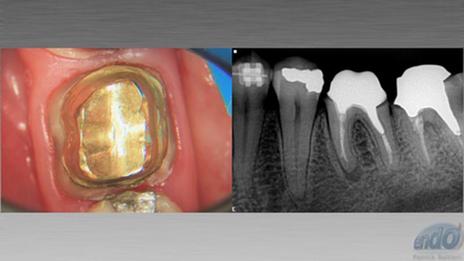 Retratamento Endodôntico - Dente 36, Caso clínico | iDent