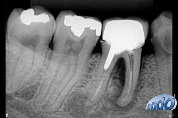 Fratura Radicular - Dente 46, Caso clínico | iDent