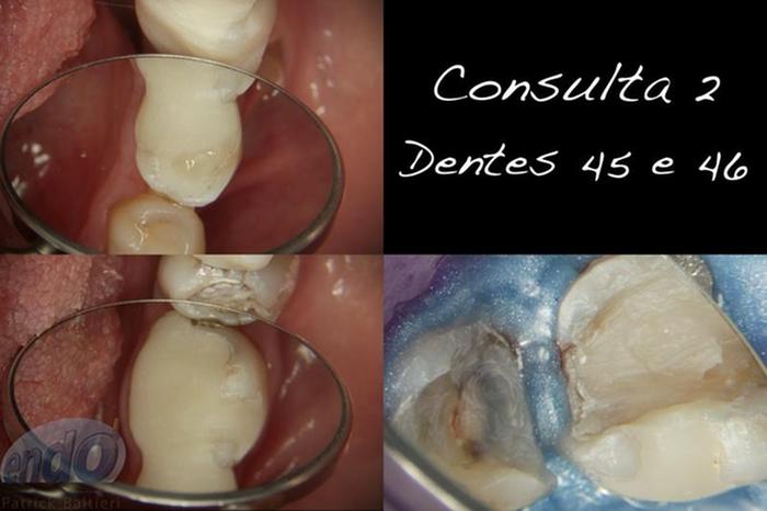 Tratamento Endodôntico dos Dentes 45 - 46 - 47, Caso clínico | iDent