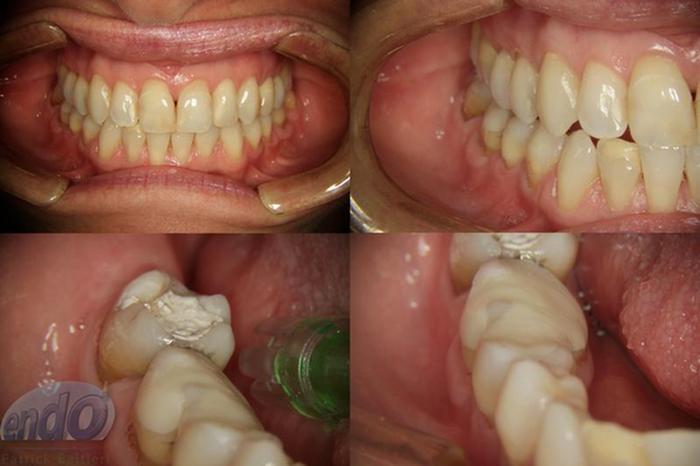Tratamento Endodôntico dos Dentes 45 - 46 - 47, Caso clínico | iDent