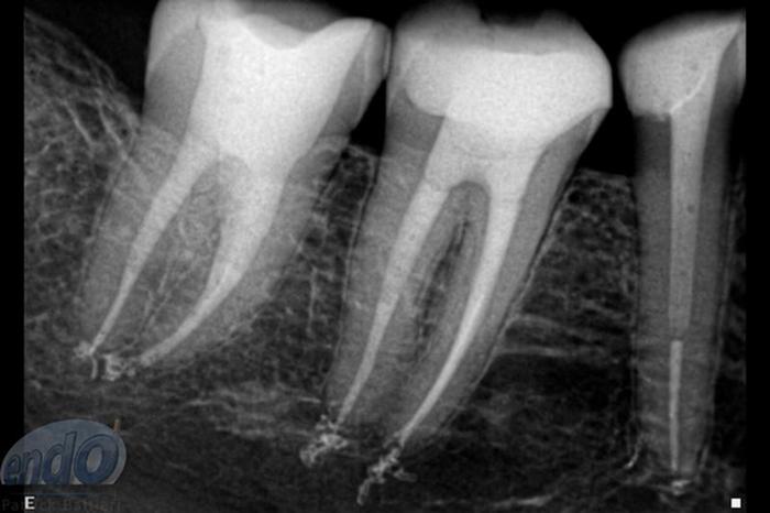 Tratamento Endodôntico dos Dentes 45 - 46 - 47, Caso clínico | iDent