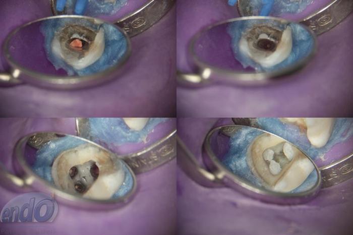 Tratamento Endodôntico dos Dentes 45 - 46 - 47, Caso clínico | iDent