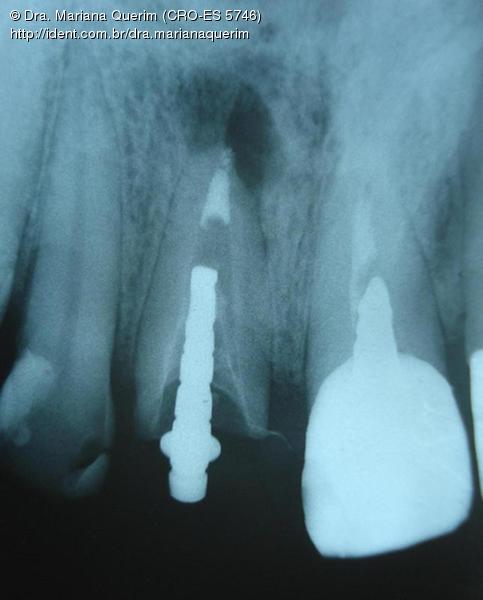 Modelagem Apical, Caso clínico | iDent